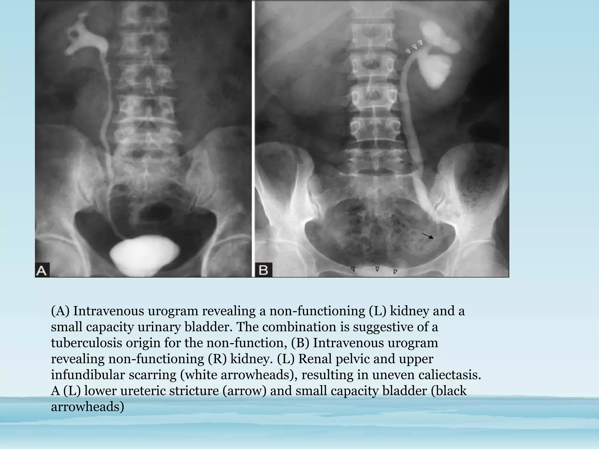 Role of imaging in renal tuberculosis | PPTX