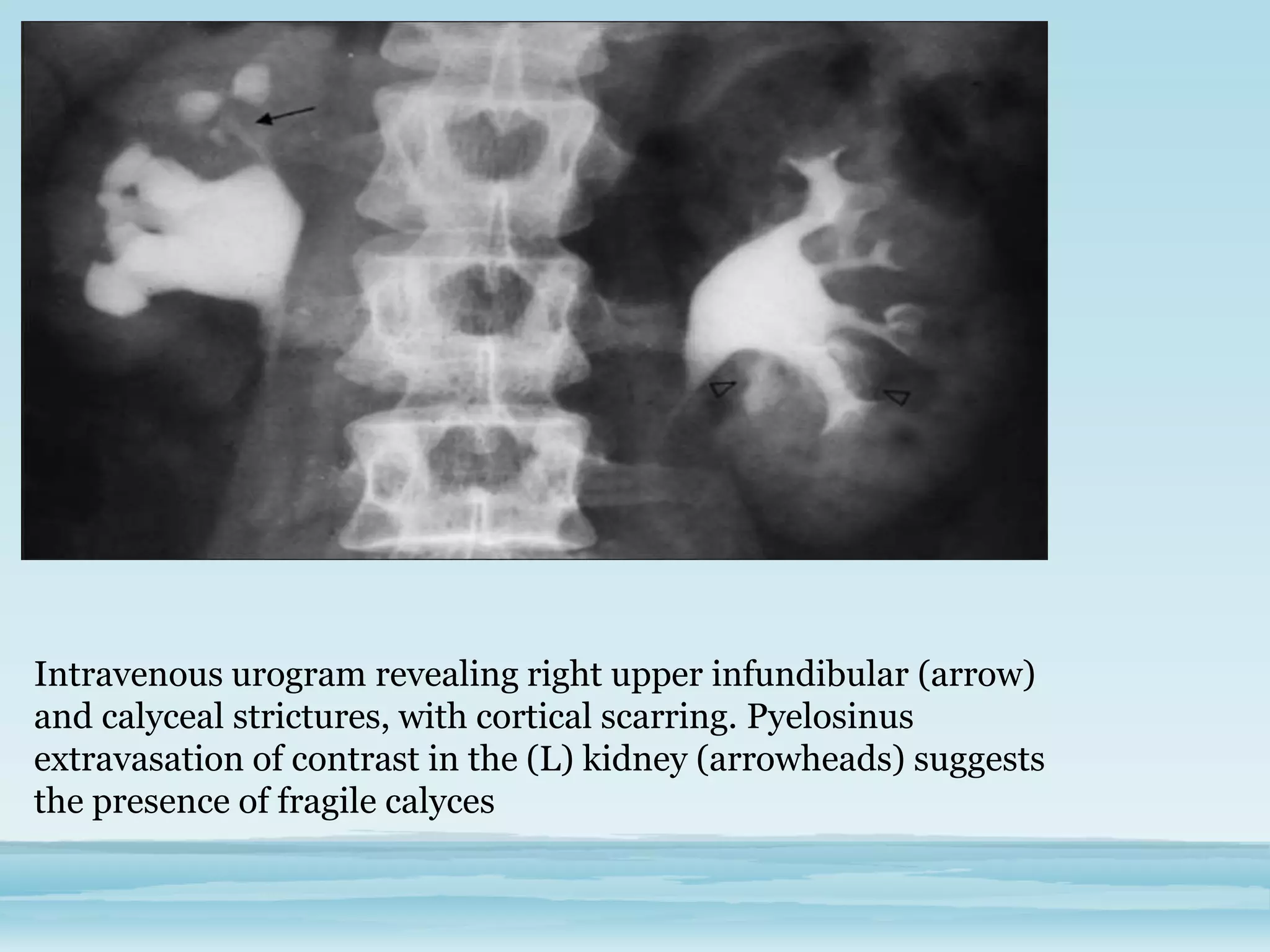 Role of imaging in renal tuberculosis | PPTX