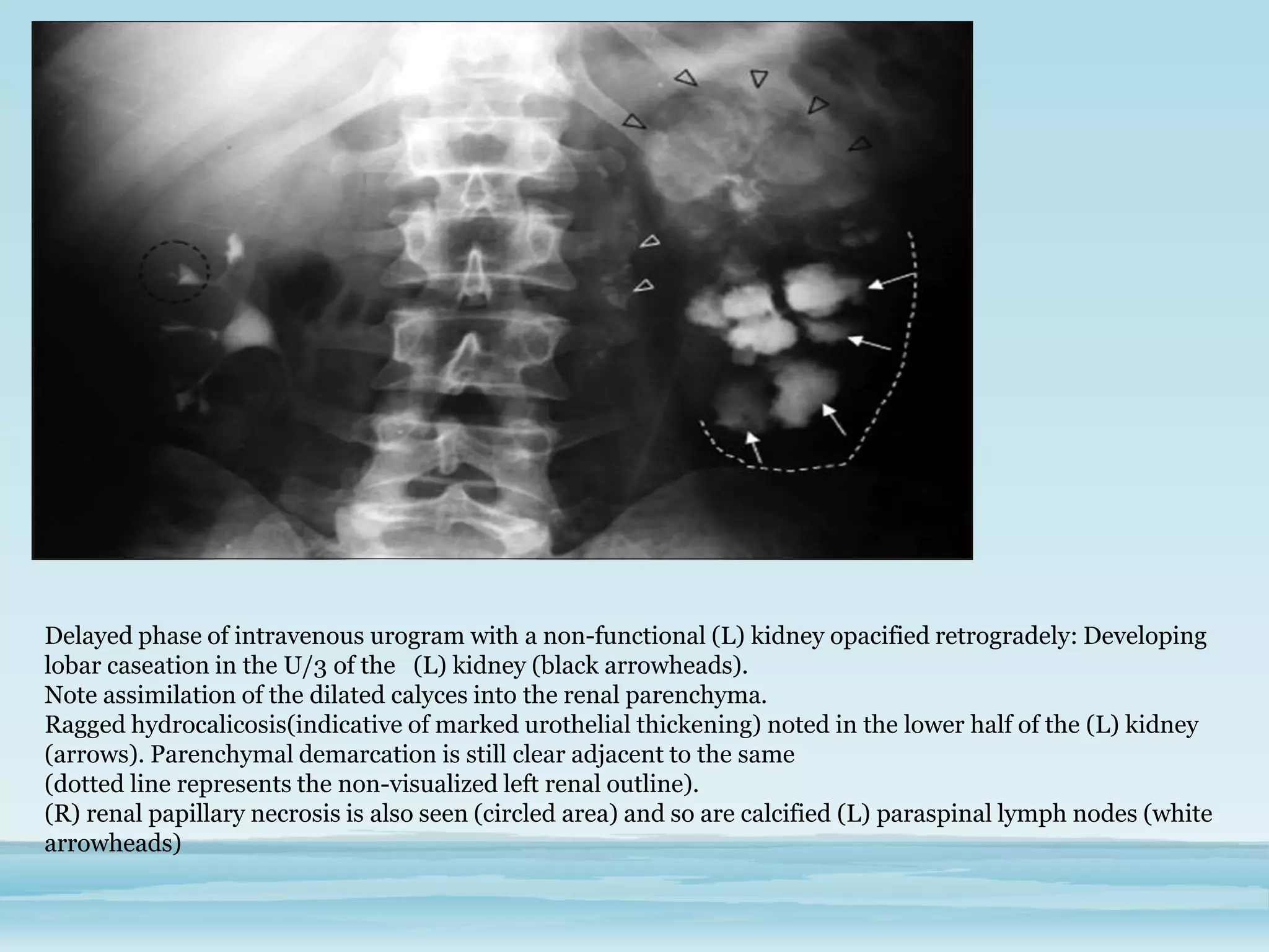 Role of imaging in renal tuberculosis | PPTX