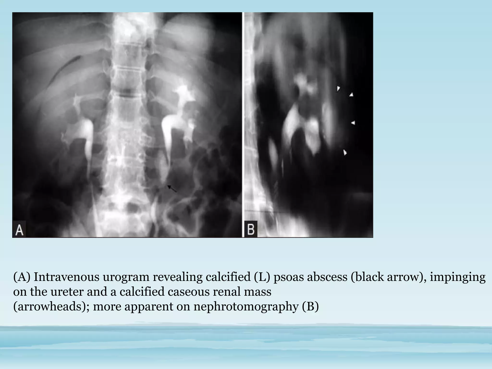 Role of imaging in renal tuberculosis | PPTX