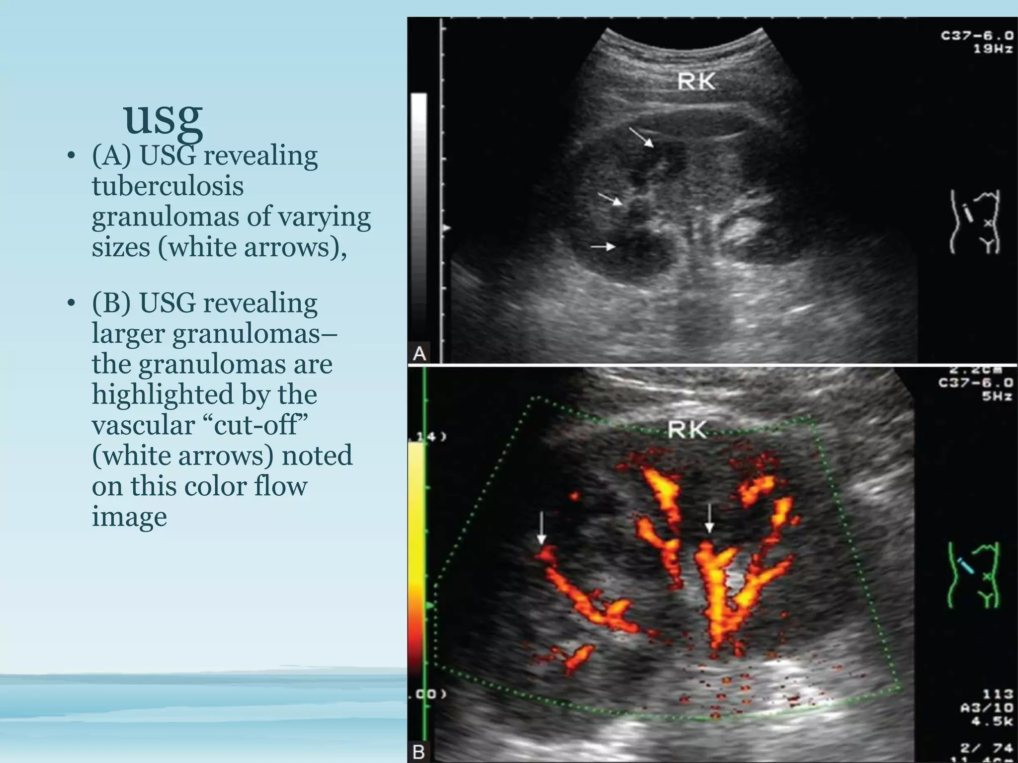 Role of imaging in renal tuberculosis | PPTX