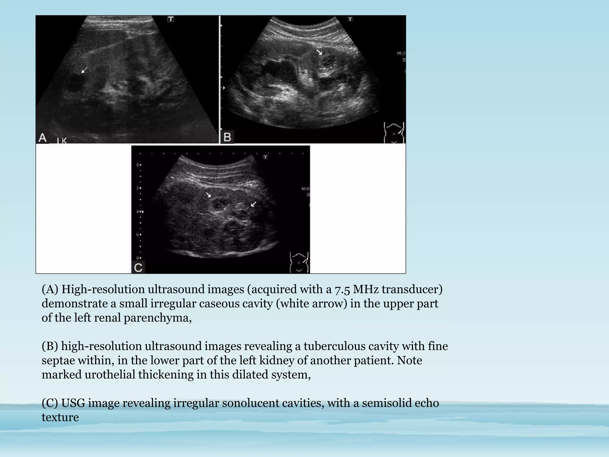 Role of imaging in renal tuberculosis | PPTX