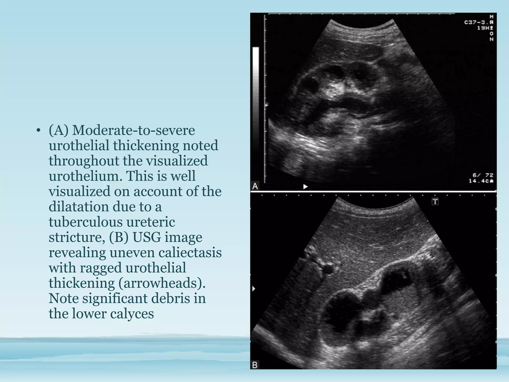 Role of imaging in renal tuberculosis | PPTX