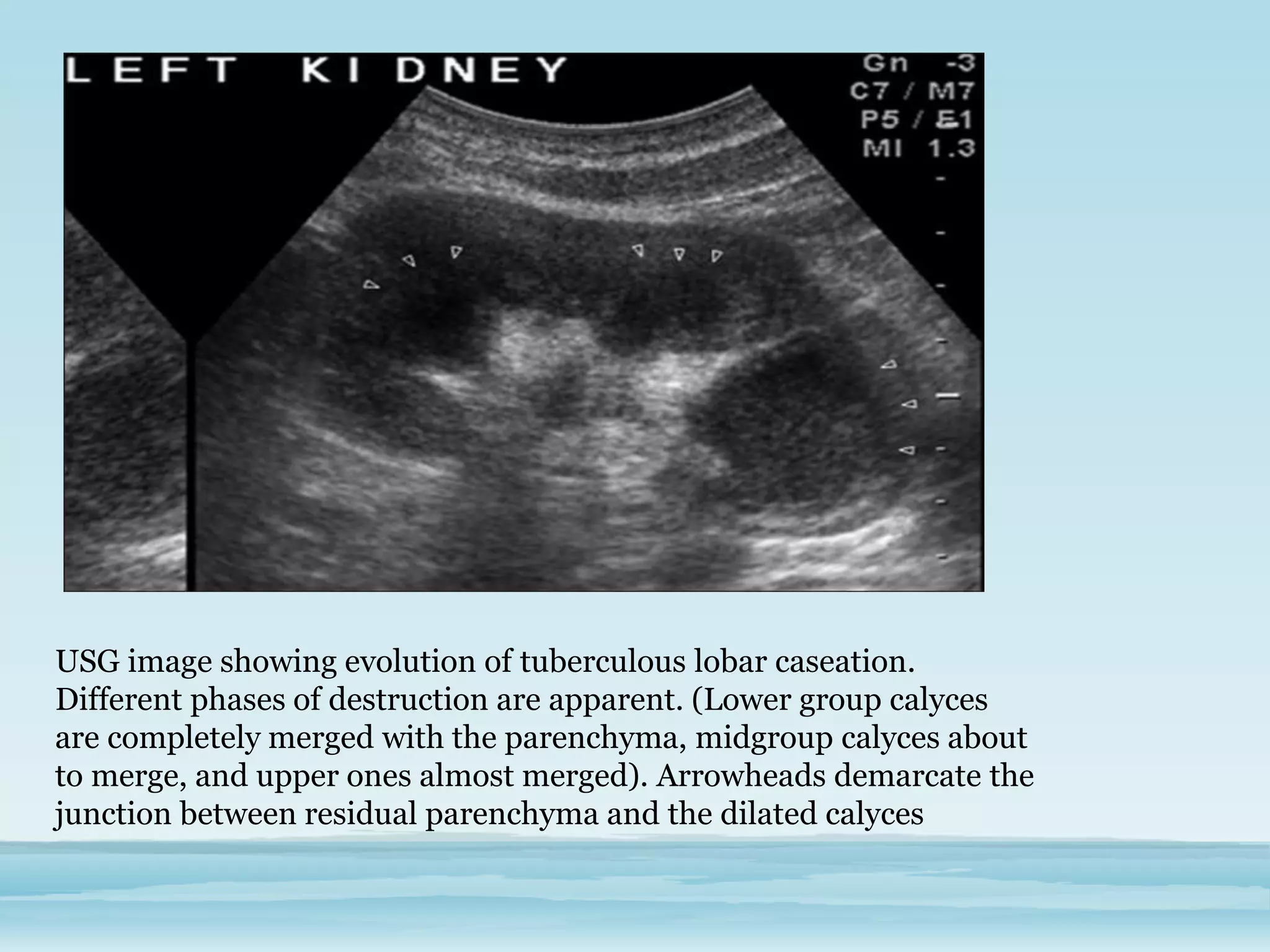 Role of imaging in renal tuberculosis | PPTX