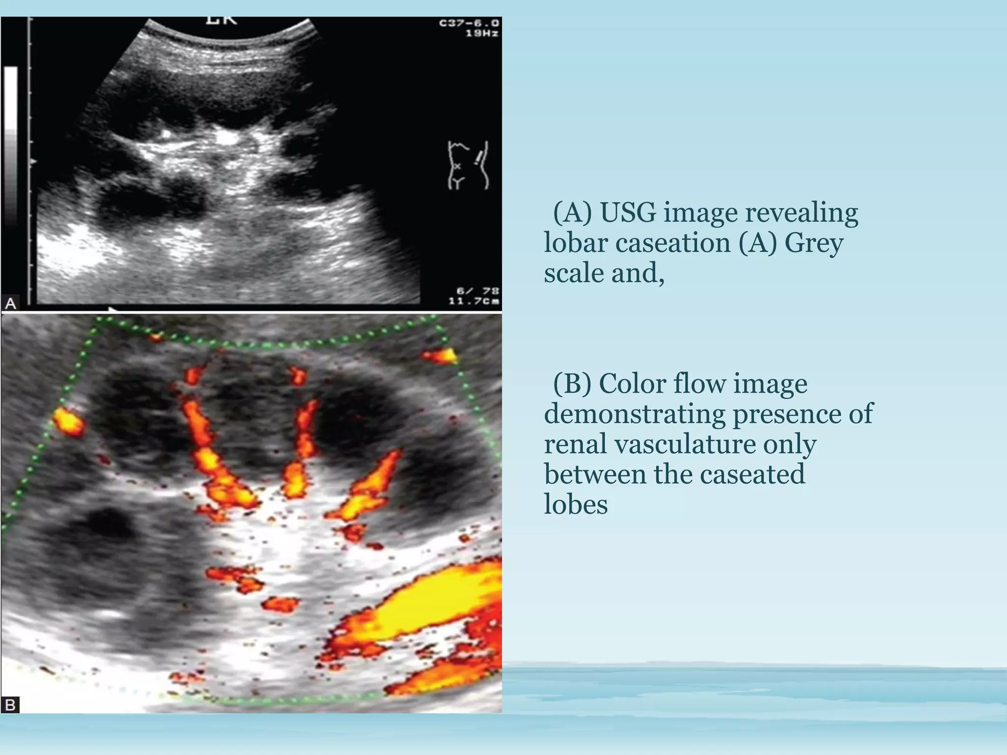 Role of imaging in renal tuberculosis | PPTX