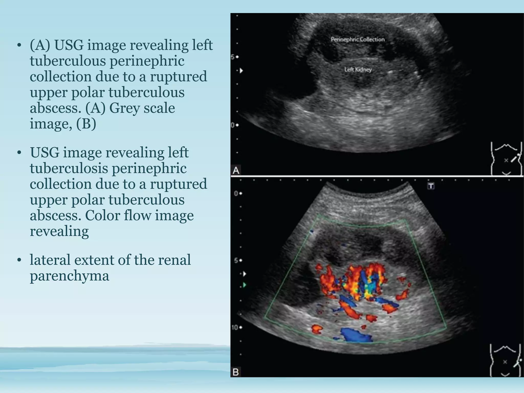 Role of imaging in renal tuberculosis | PPTX