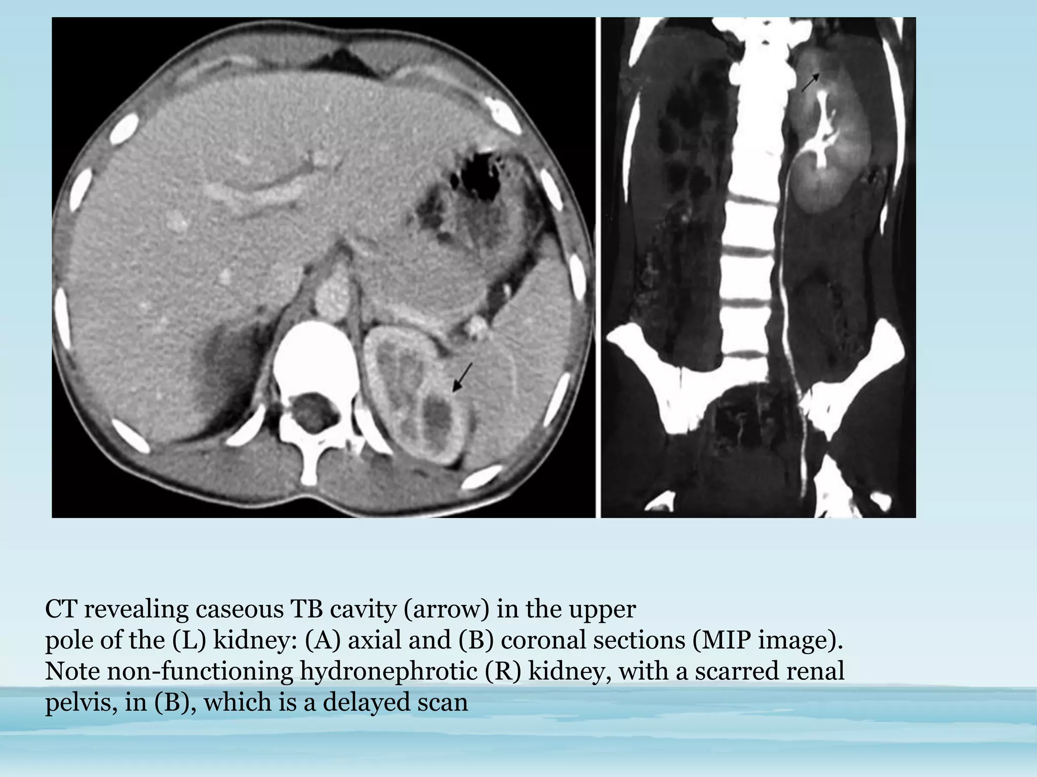 Role of imaging in renal tuberculosis | PPTX