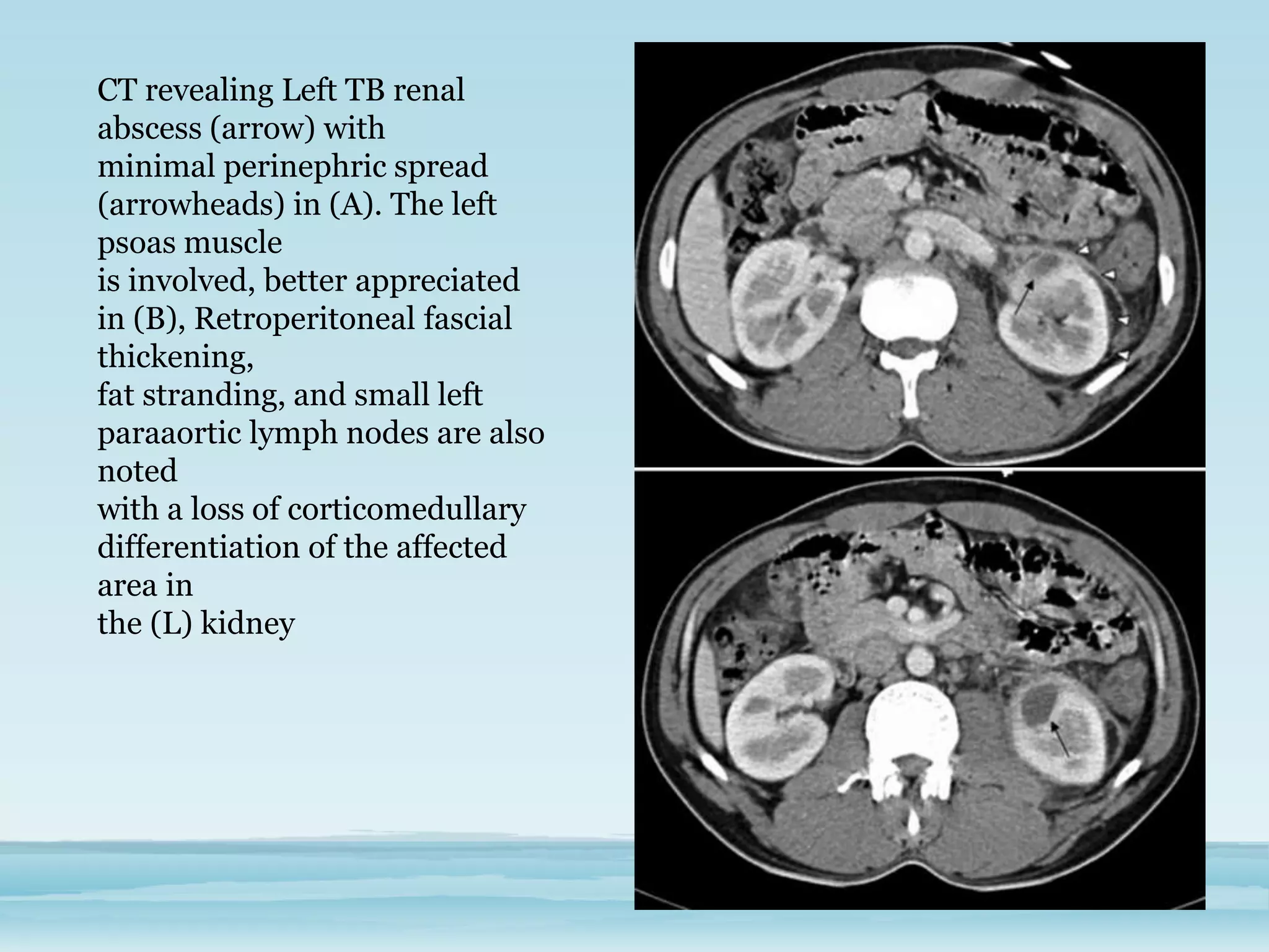 Role of imaging in renal tuberculosis | PPTX
