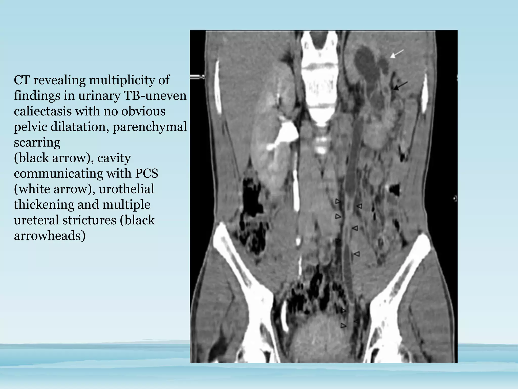 Role of imaging in renal tuberculosis | PPTX