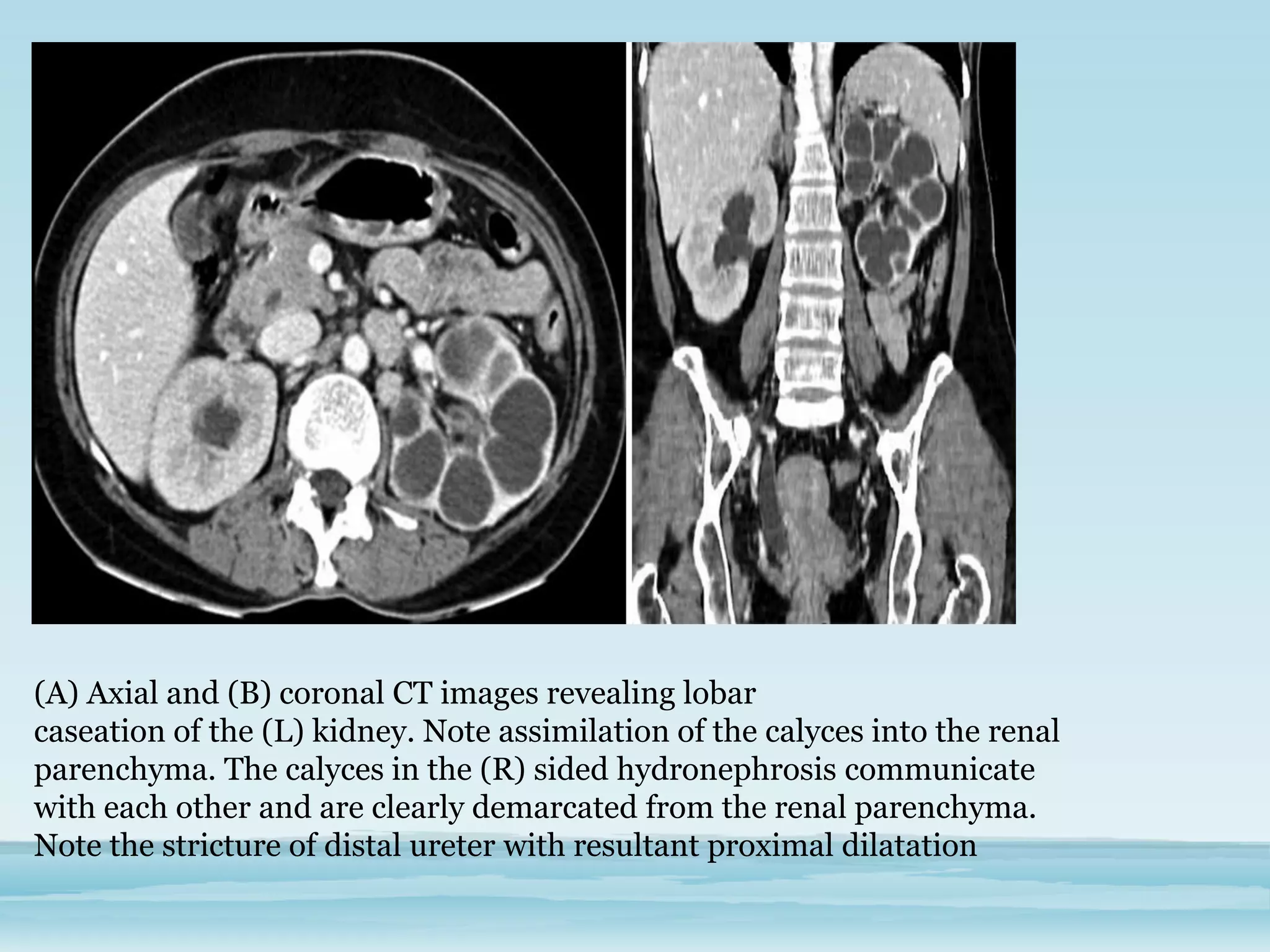 Role of imaging in renal tuberculosis | PPTX