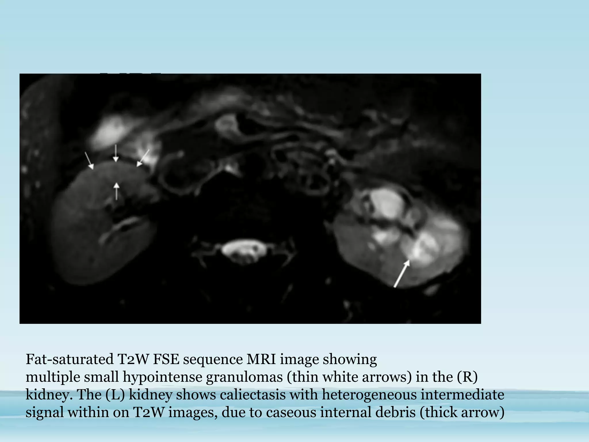 Role of imaging in renal tuberculosis | PPTX