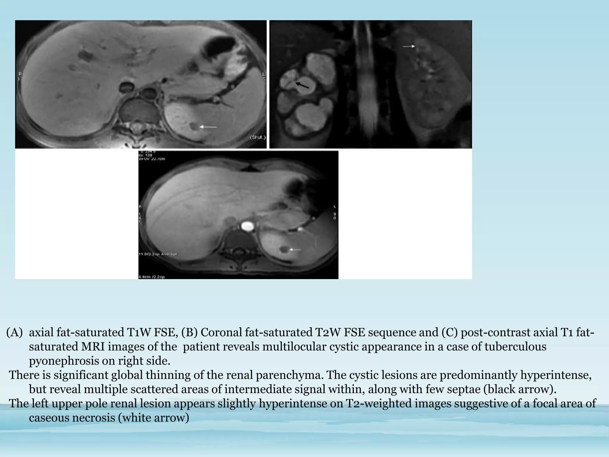 Role of imaging in renal tuberculosis | PPTX