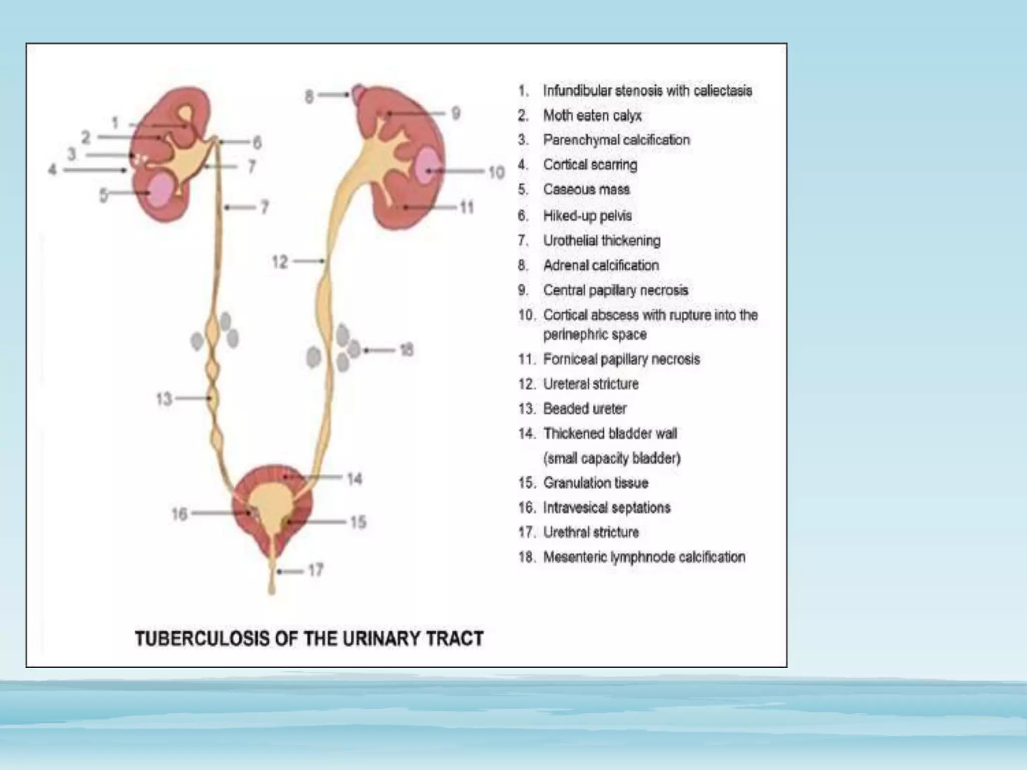 Role of imaging in renal tuberculosis | PPTX