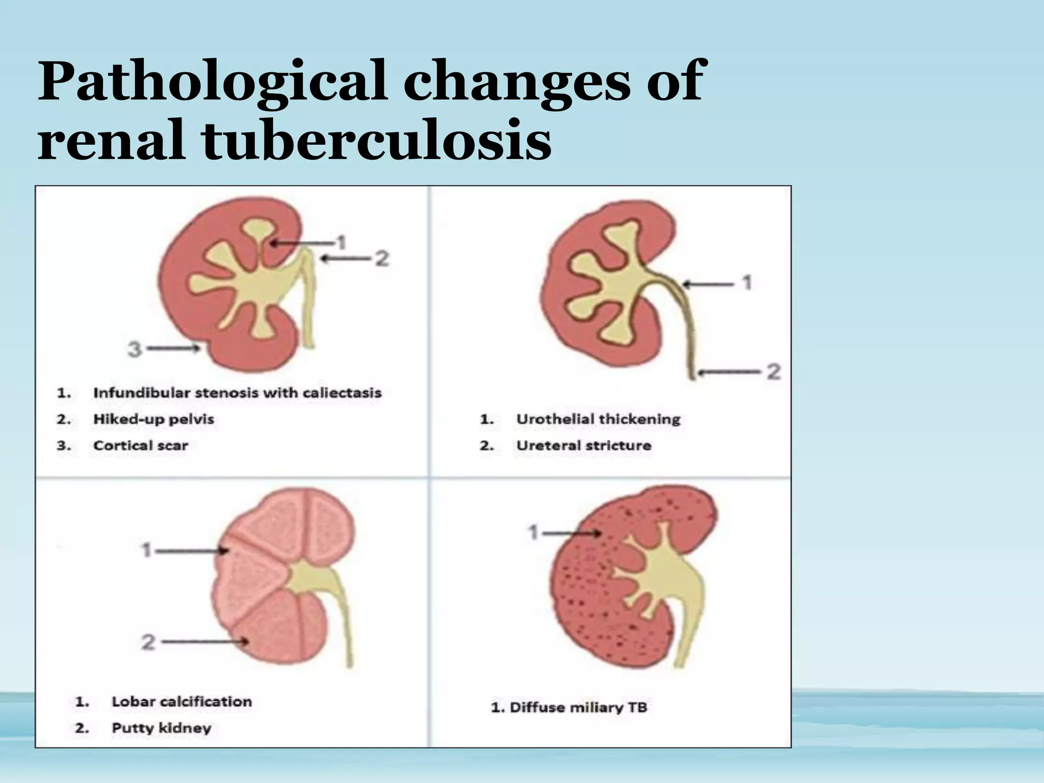 Role of imaging in renal tuberculosis | PPTX