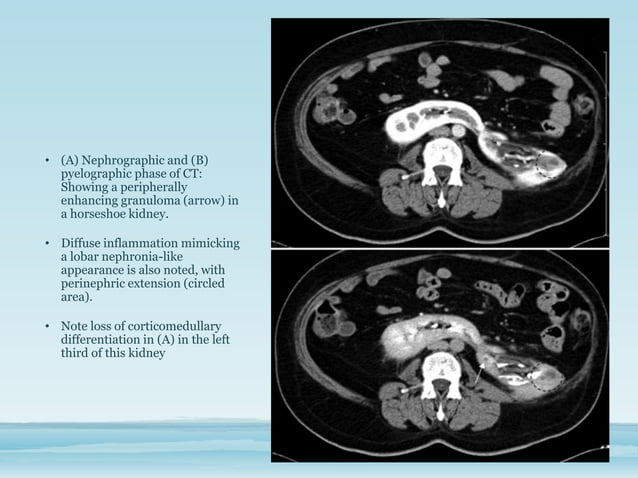 Role of imaging in renal tuberculosis | PPTX