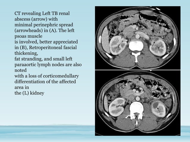 Role of imaging in renal tuberculosis | PPTX