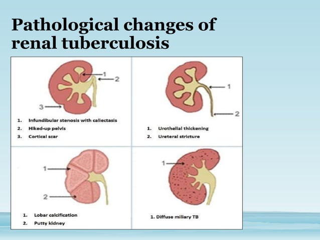 Role of imaging in renal tuberculosis | PPTX