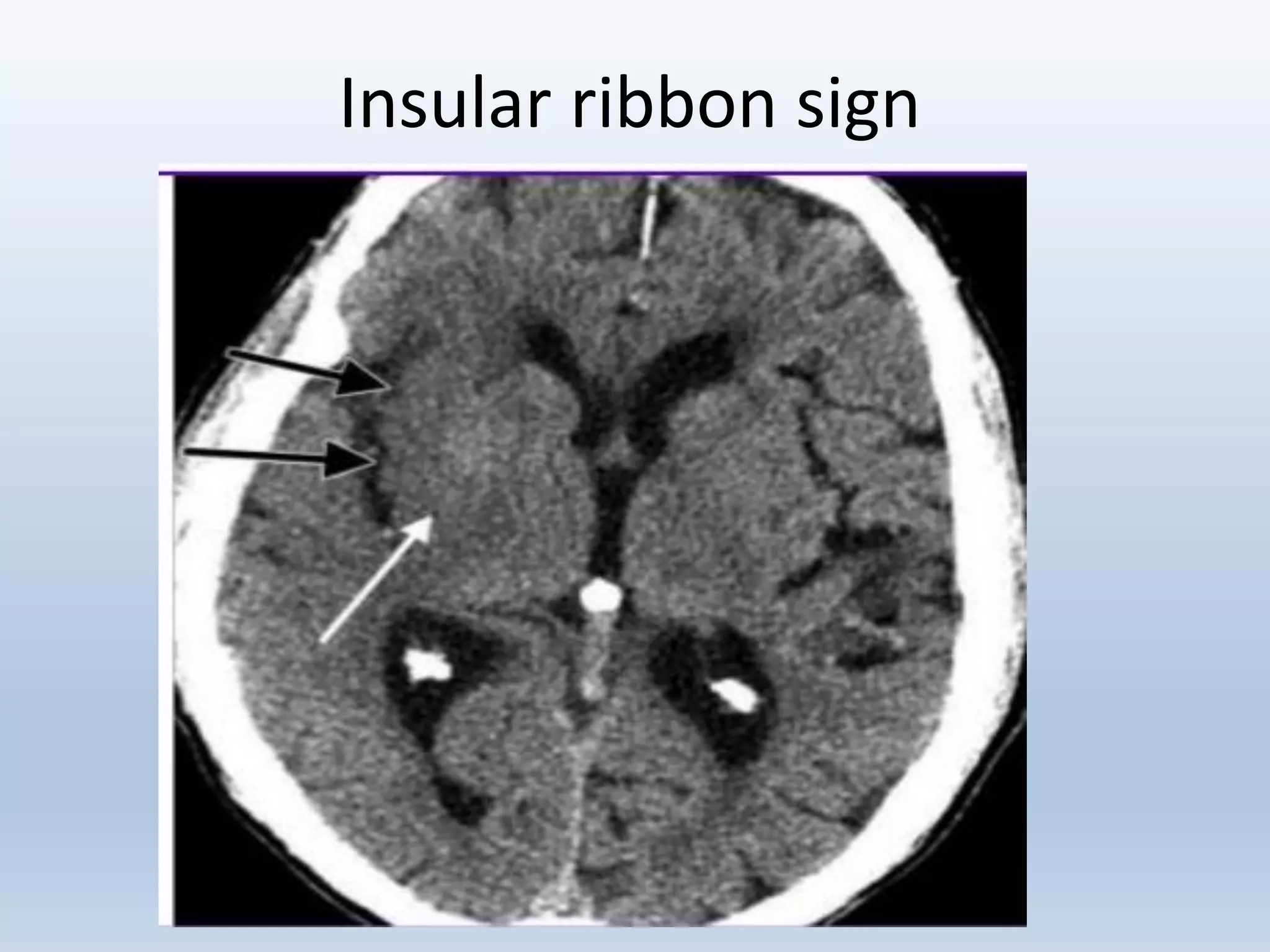 Role of imaging in stroke pk pdf ppt | PDF