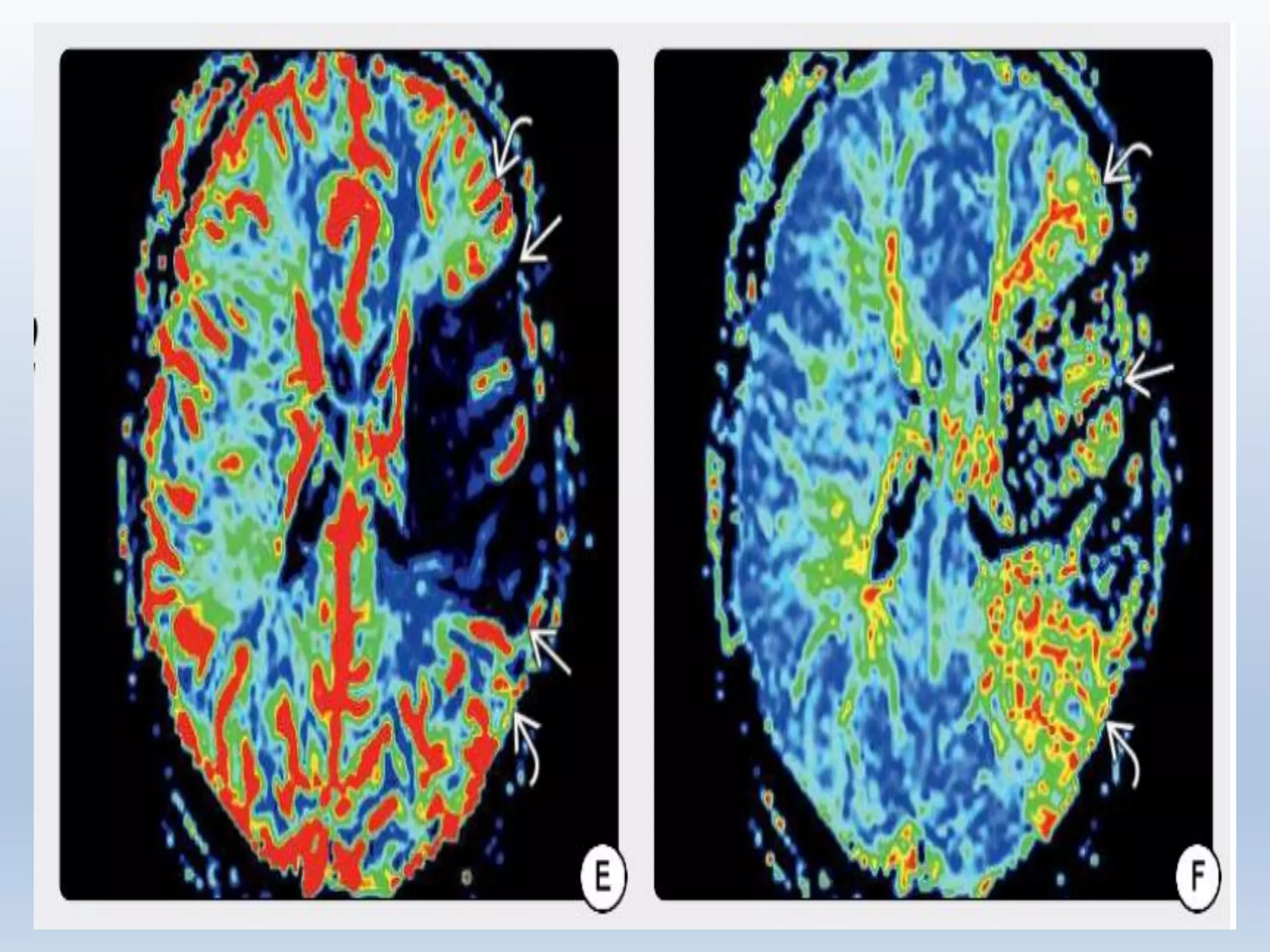 Role of imaging in stroke pk pdf ppt | PDF | Brain and Nervous System ...