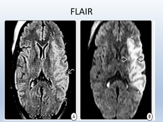 Role of imaging in stroke pk pdf ppt | PDF