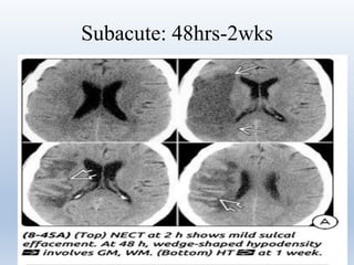 Role of imaging in stroke pk pdf ppt | PDF