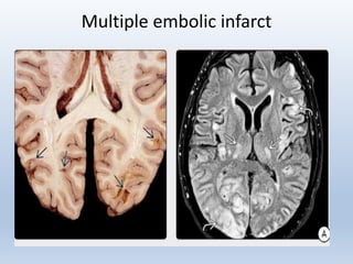 Role of imaging in stroke pk pdf ppt | PDF