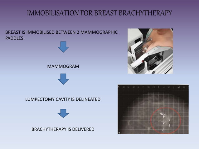 Role of immobilisation and devices in radiotherapy | PPTX