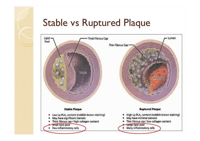 Role of Inflammation in Patophysiology of ACS