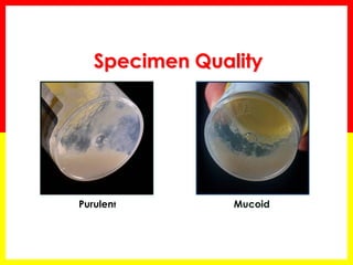 Mucopurulent Sputum Sample