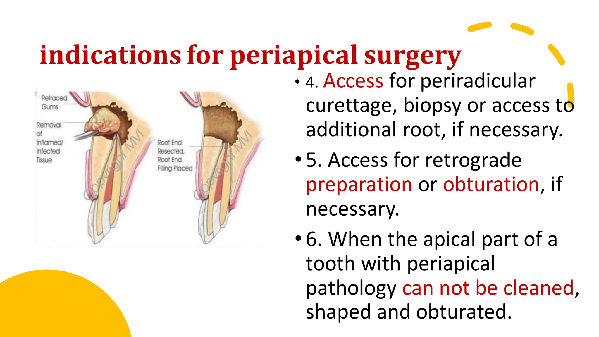 role of laser in periapical surgery rania asaad.pdf