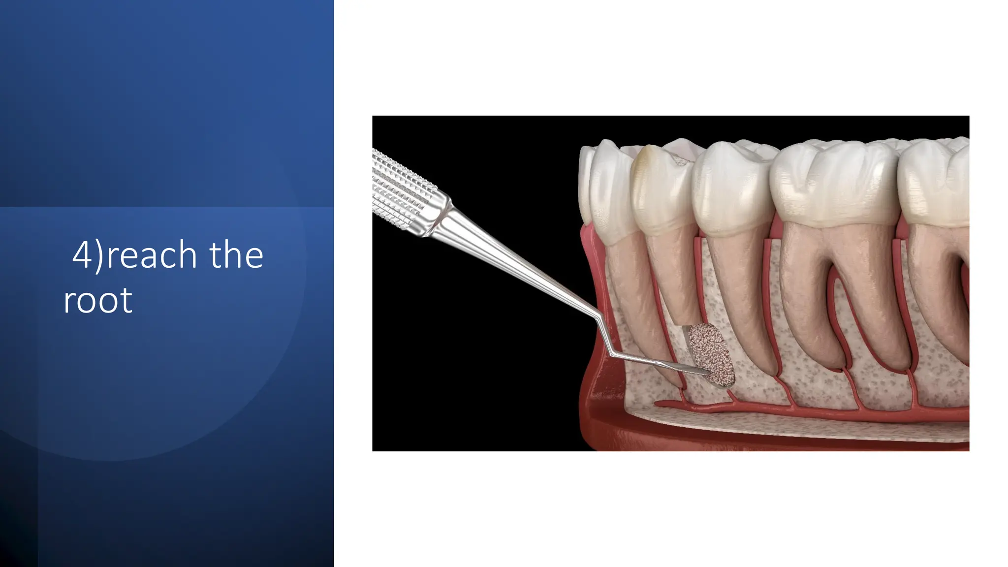 role of laser in periapical surgery rania asaad.pdf