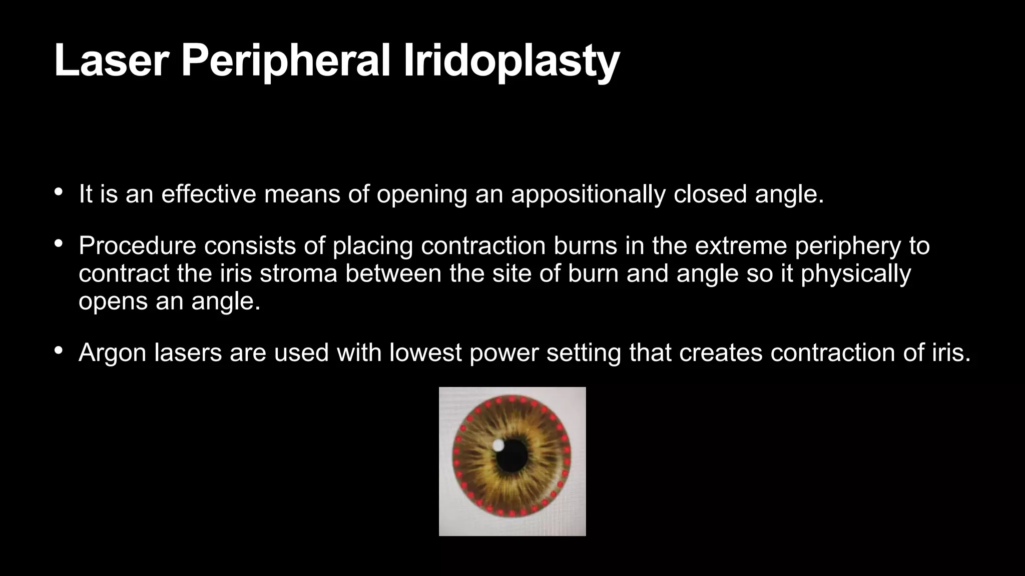 Role of lasers in Glaucoma.pptx
