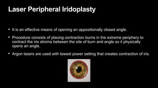 Role of lasers in Glaucoma.pptx