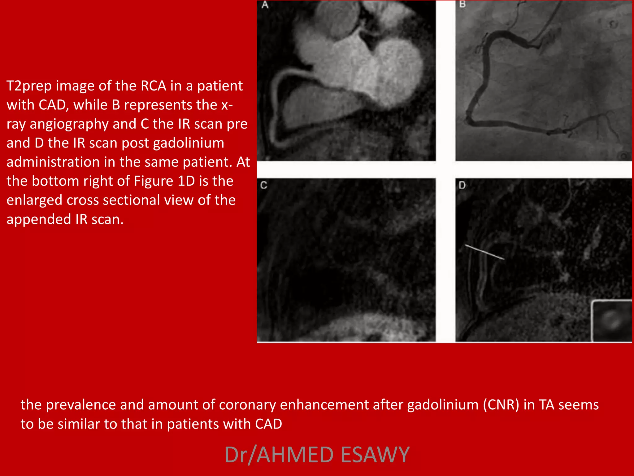 Role of magnetic resonance imaging in coronary artery disease MRCA part ...