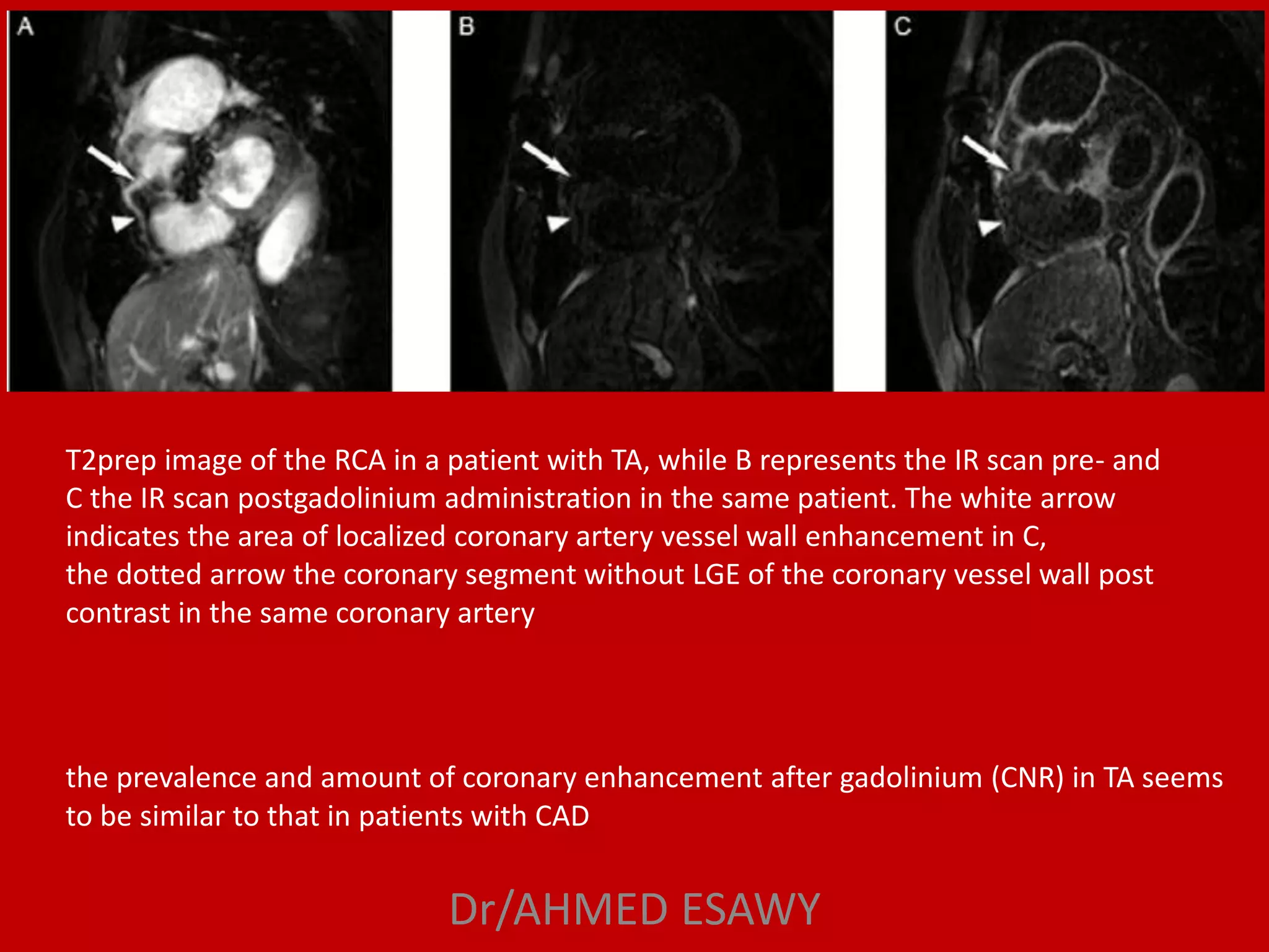 Role of magnetic resonance imaging in coronary artery disease MRCA part ...