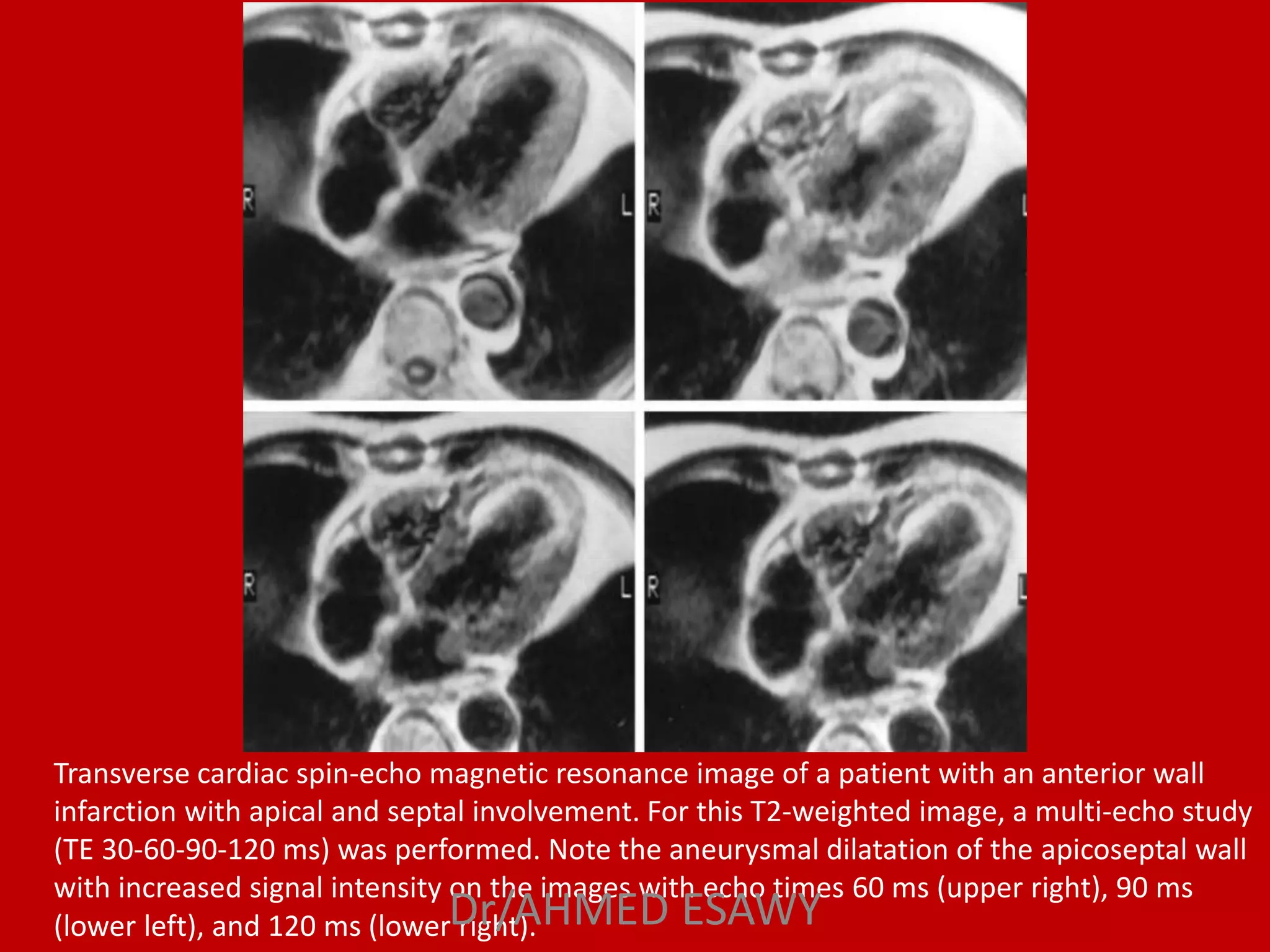 Role of magnetic resonance imaging in coronary artery disease MRCA part ...