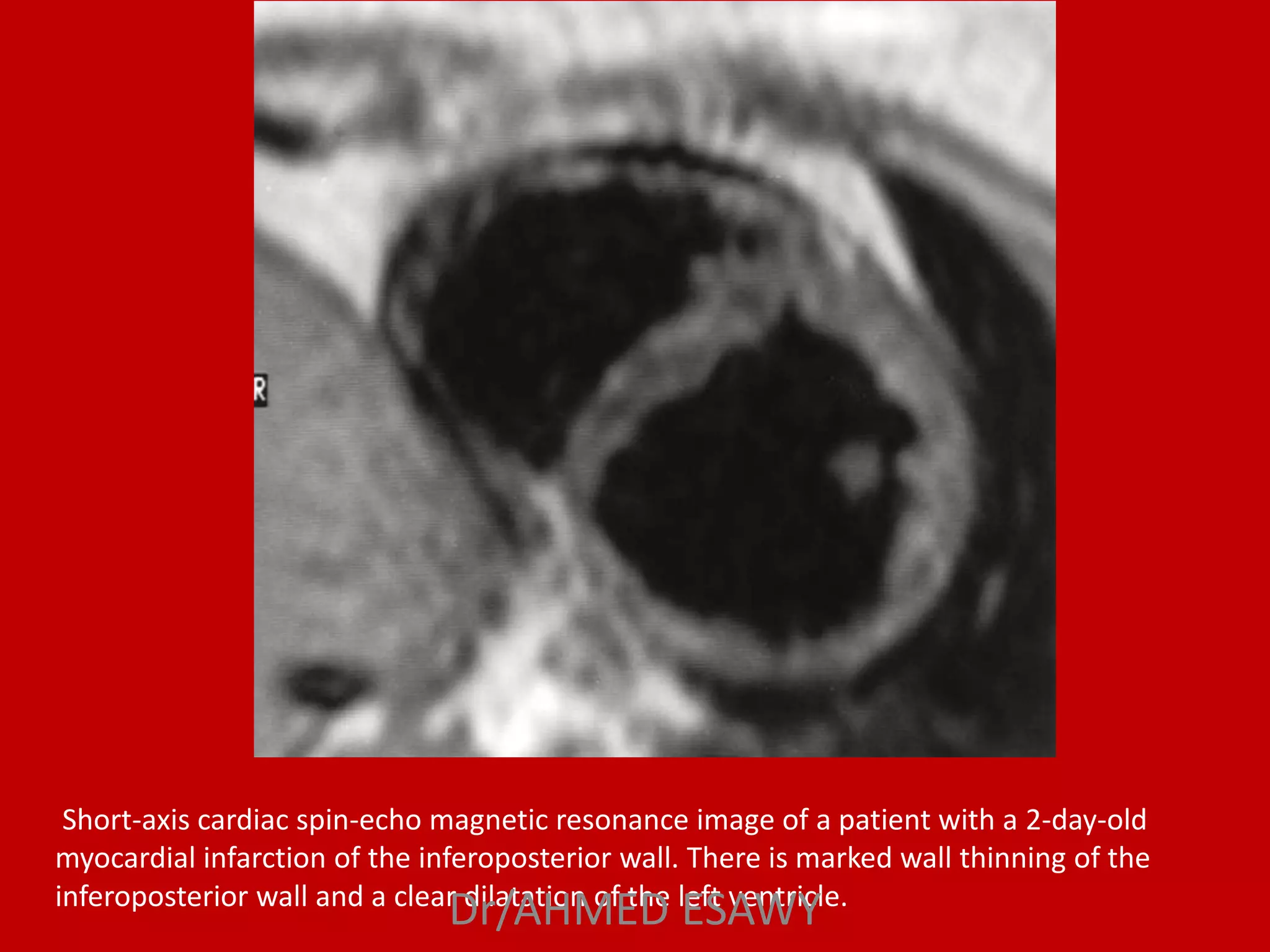 Role of magnetic resonance imaging in coronary artery disease MRCA part ...