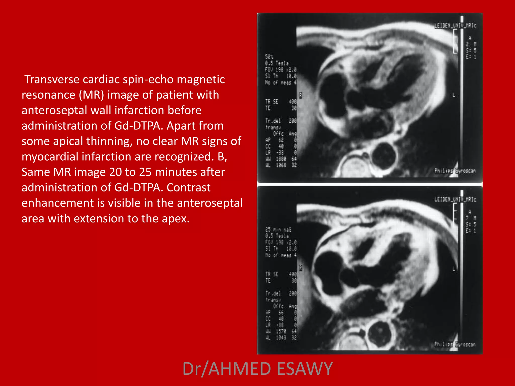 Role of magnetic resonance imaging in coronary artery disease MRCA part ...