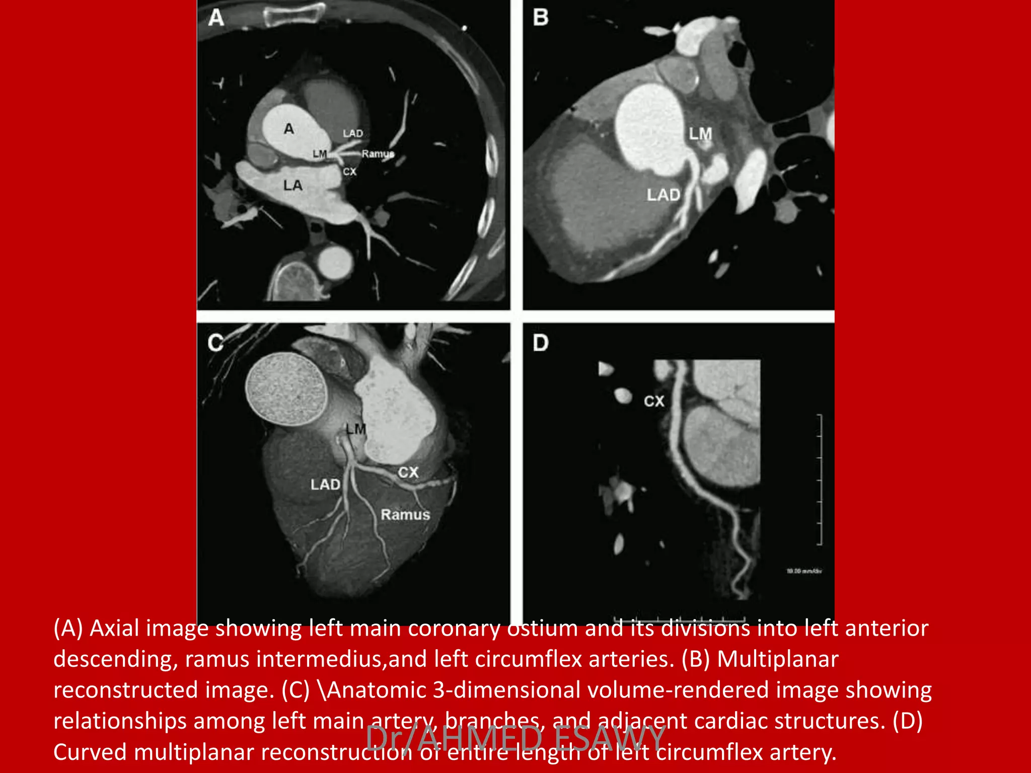 Role of magnetic resonance imaging in coronary artery disease MRCA part ...