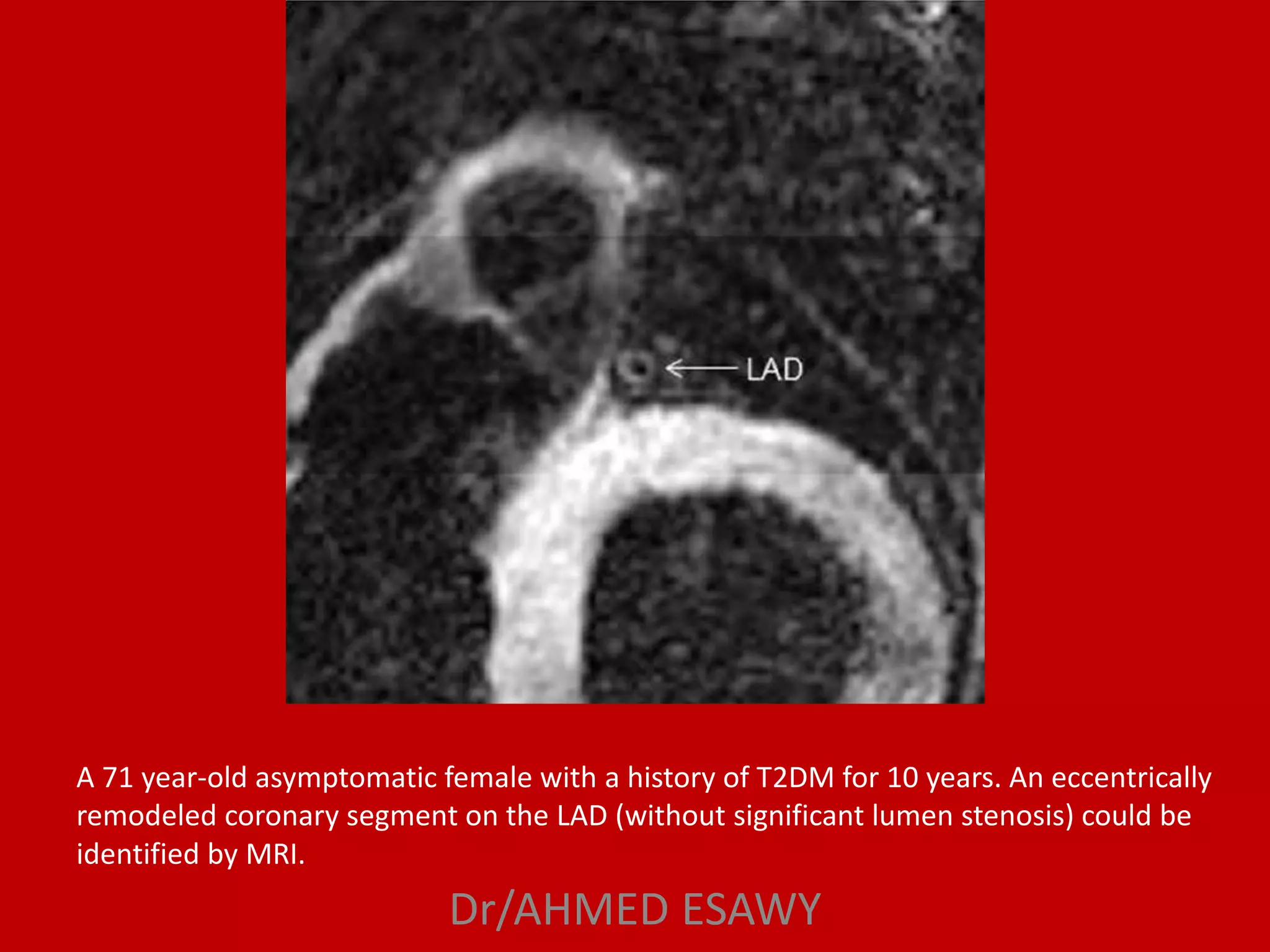 Role of magnetic resonance imaging in coronary artery disease MRCA part ...