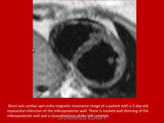 Role of magnetic resonance imaging in coronary artery disease MRCA part ...