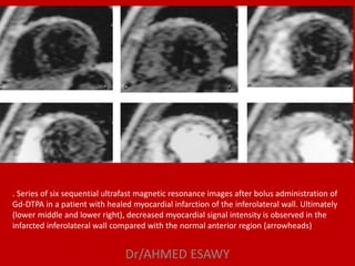 Role of magnetic resonance imaging in coronary artery disease MRCA part ...