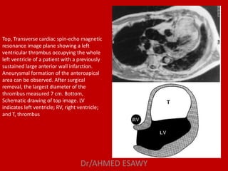 Role of magnetic resonance imaging in coronary artery disease MRCA part ...