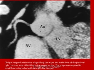 Role of magnetic resonance imaging in coronary artery disease MRCA part ...