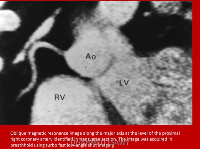 Role of magnetic resonance imaging in coronary artery disease MRCA part ...