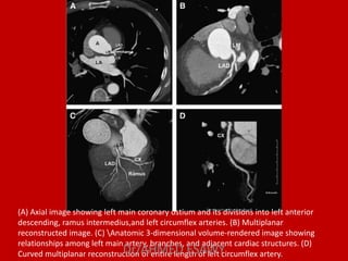 Role of magnetic resonance imaging in coronary artery disease MRCA part ...