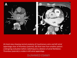 Role of magnetic resonance imaging in coronary artery disease MRCA part ...