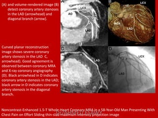 Role of magnetic resonance imaging in coronary artery disease MRCA part ...