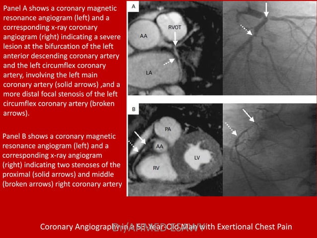 Role of magnetic resonance imaging in coronary artery disease MRCA part ...