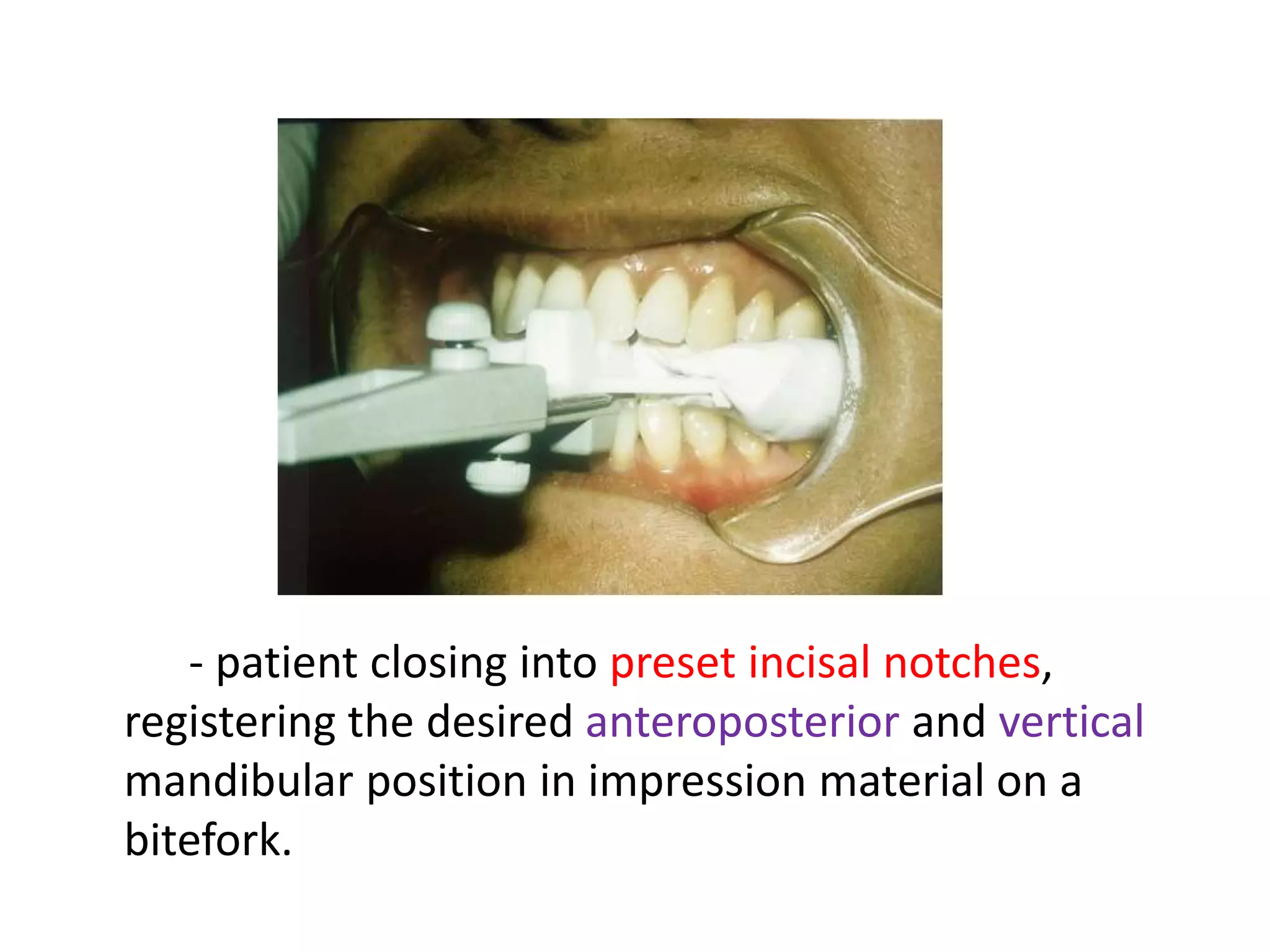 Role of mandibular advancement splint in sleep apnoea | PPTX